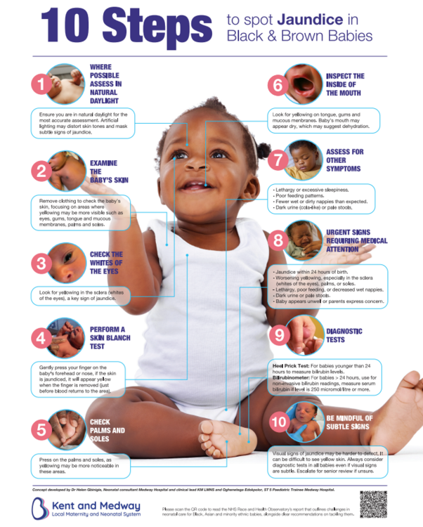 NHS Race and Health Observatory: Ten steps to spot jaundice in black and brown babies (30 ...